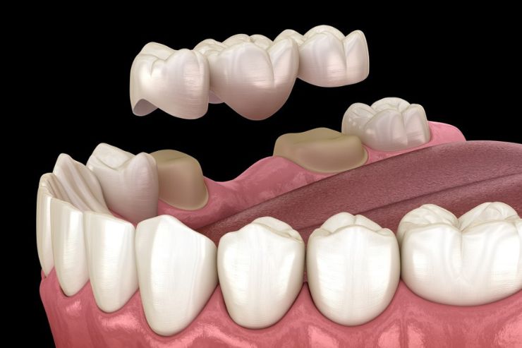 Dental Bridges - Star Smiles Dental Care